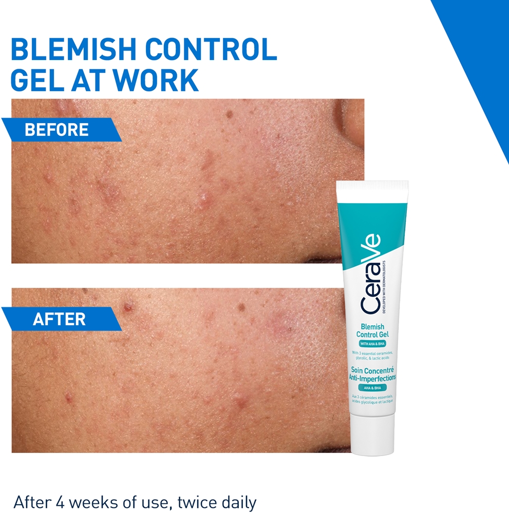 CeraVe Blemish Control Gel topical treatment to treat skin ...