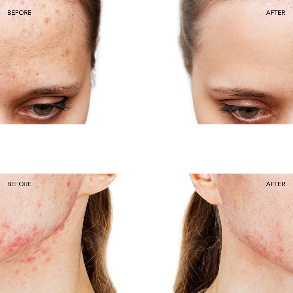 FOREO ESPADA™ 2 lápiz con luz azul para tratar los síntomas del acné ...