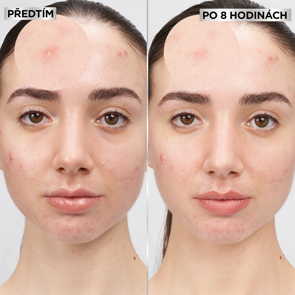 Garnier Pure Active Pimple Patch náplasti na problematickou pleť proti ...