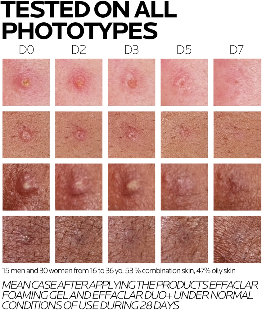 La Roche-Posay Effaclar DUO (+M) korrigierende und erneuernde Pflege ...