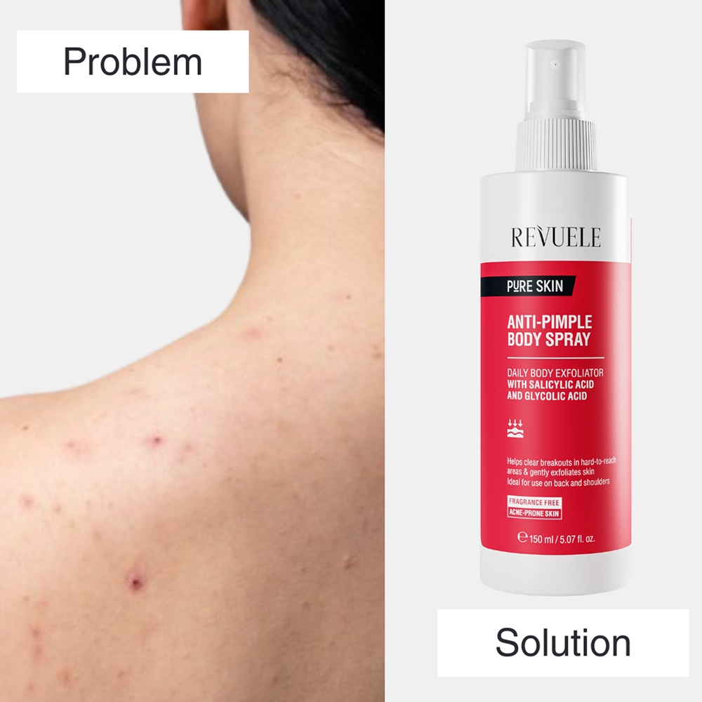Revuele Pure Skin Anti-Pimple Body Spray to treat acne | notino.ie
