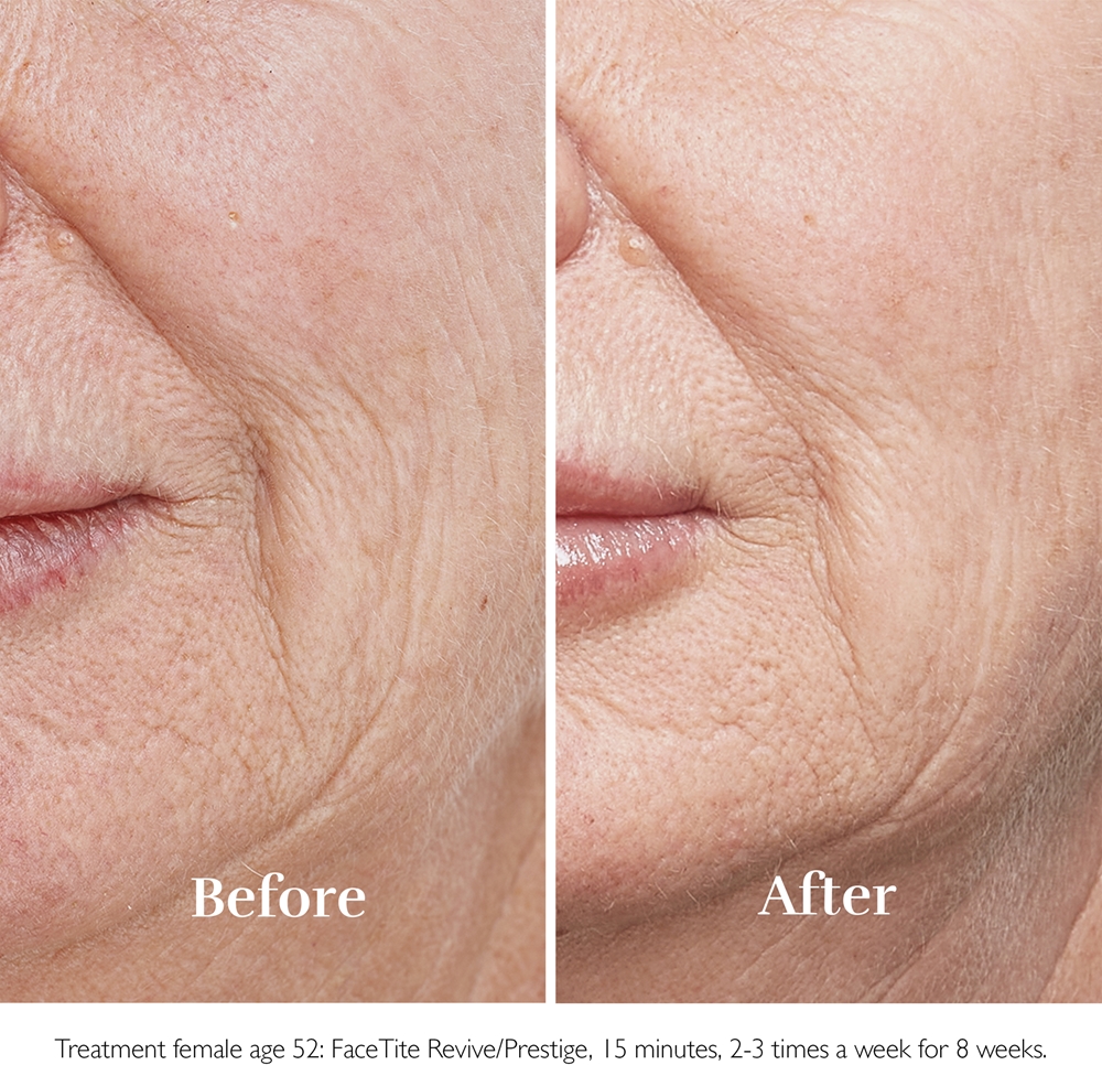 Silk'n FaceTite Essential wrinkle smoothing and reducing device | notino.ie