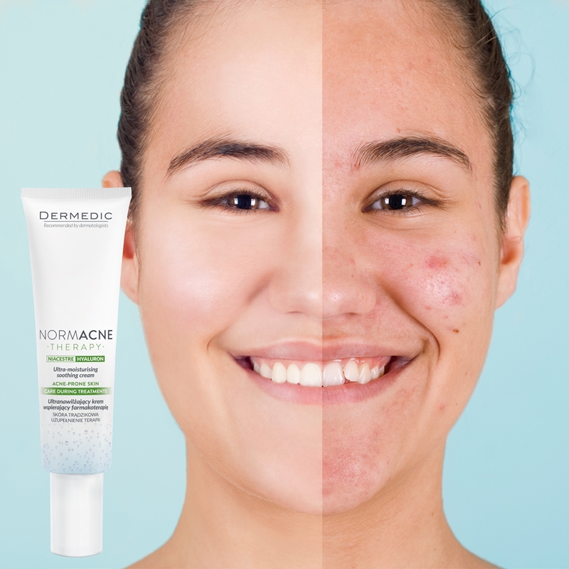Dermedic Normacne Therapy moisturising cream for acne-prone skin ...
